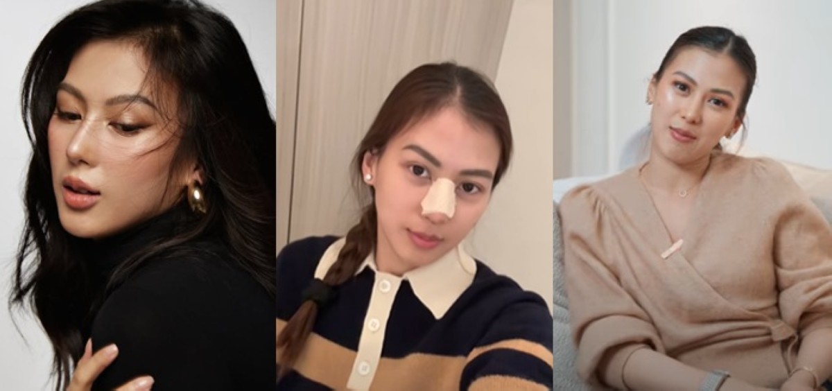 'Back to normal nose!' Alex Gonzaga, pinatanggal pinalagay sa ilong-Balita