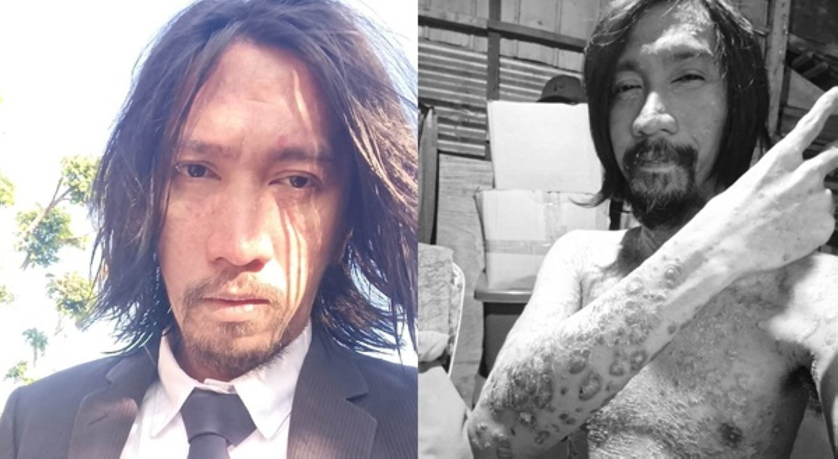 John Weak, tinamaan ng sakit sa balat-Balita